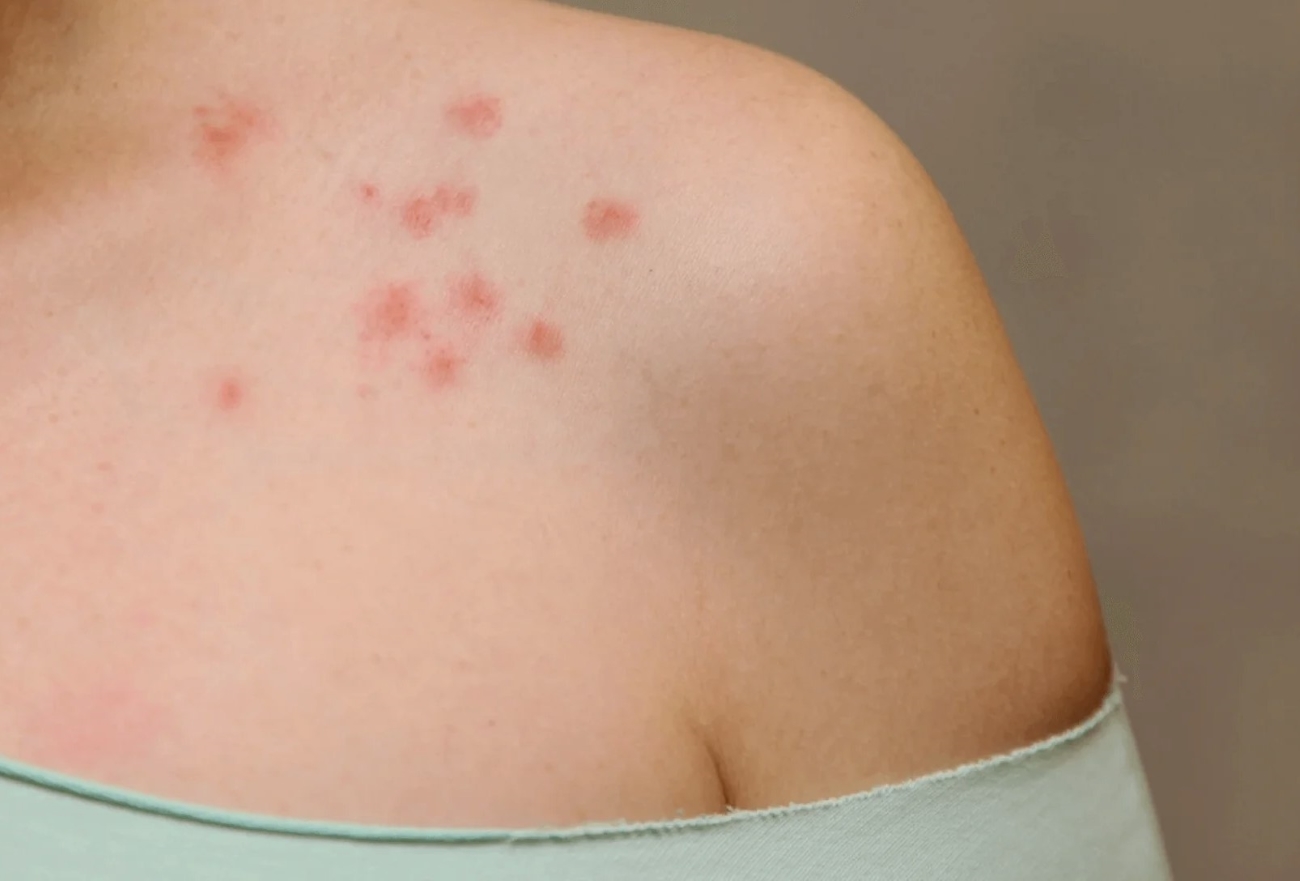 Manchas de dengue: como são e quais cuidados ter – Bernadete Alves ...